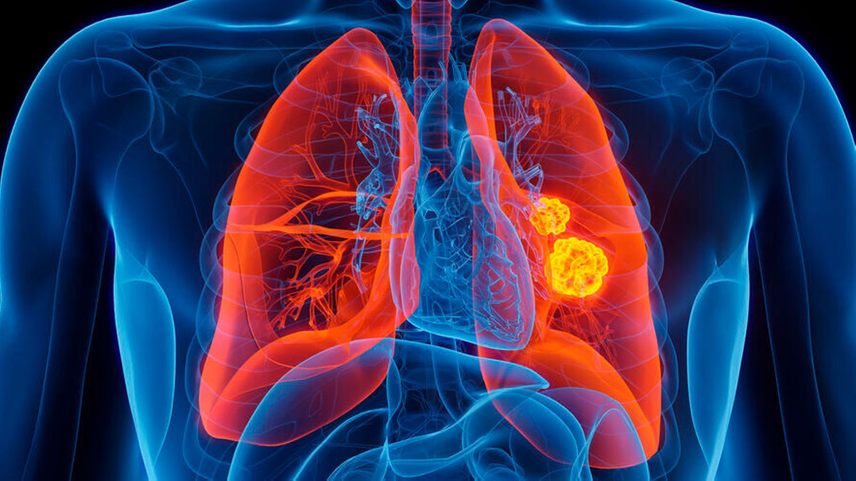 HER2-mutiertes NSCLC: Neue Daten zu BAY 2927088