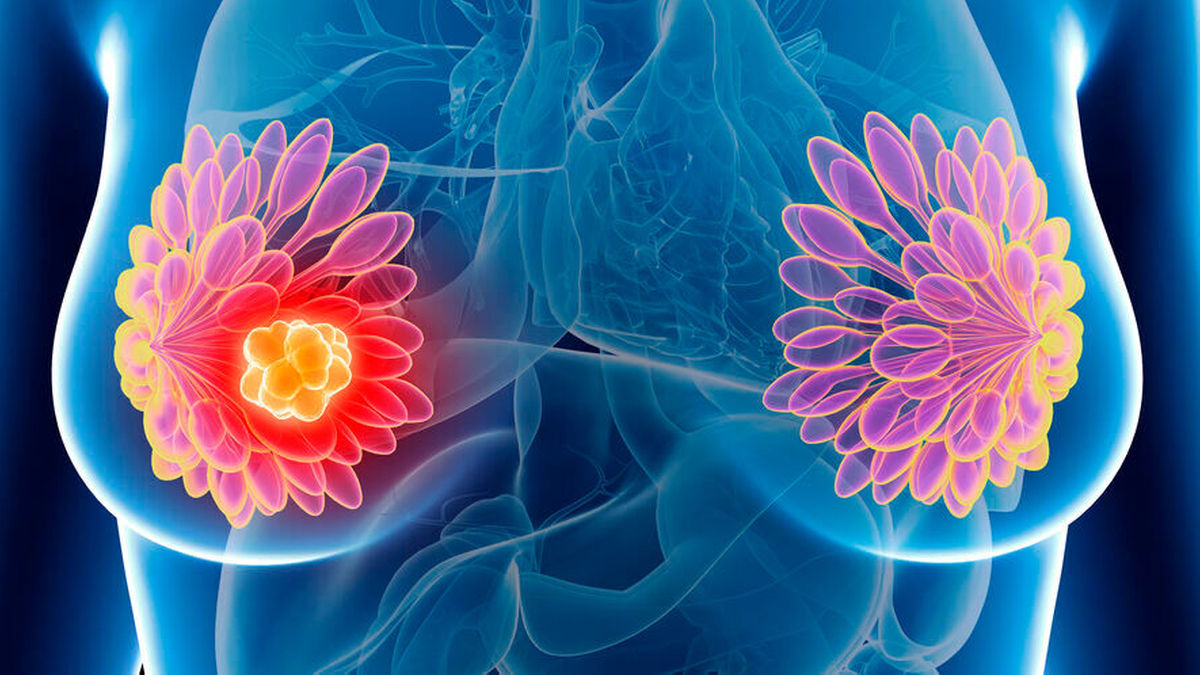 Früher Einsatz von ADC beim HER2+ Mammakarzinom