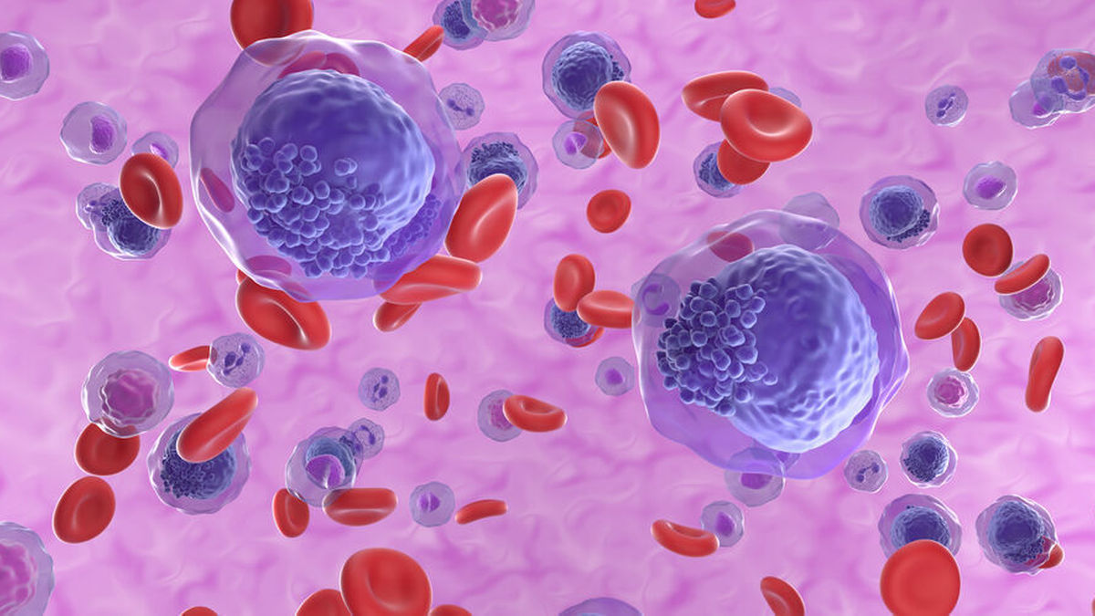 AML mit IDH1-Mutation: Ivosidenib ist Venetoclax überlegen