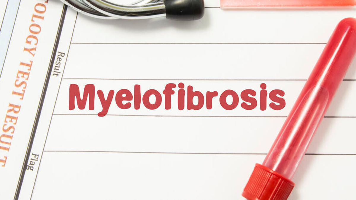 Myelofibrose: BET- plus JAK-Inhibitoren verträglich und wirksam