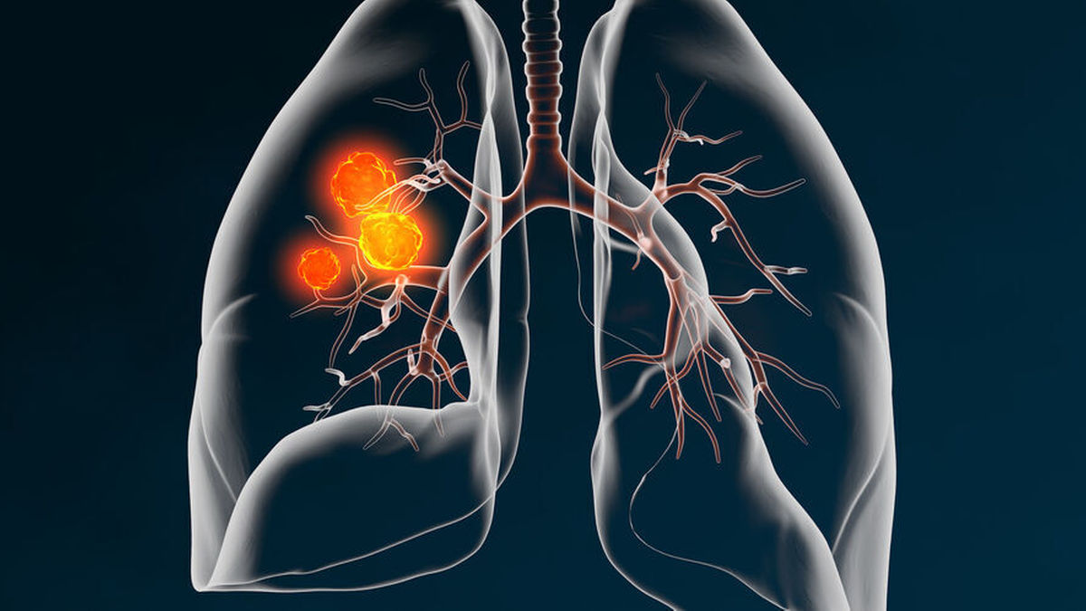 PFS-Vorteil mit Osimertinib + CT bei EGFR-mutiertem NSCLC