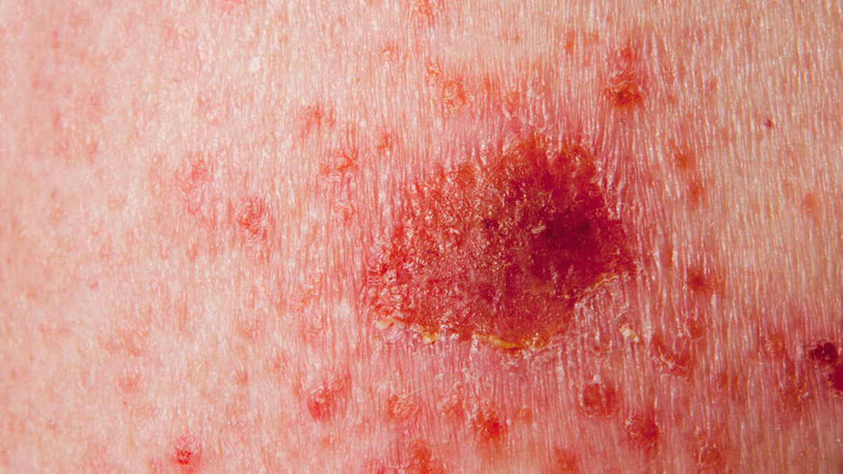 Merkelzellkarzinom + Immunsuppression: Behandlung mit Avelumab