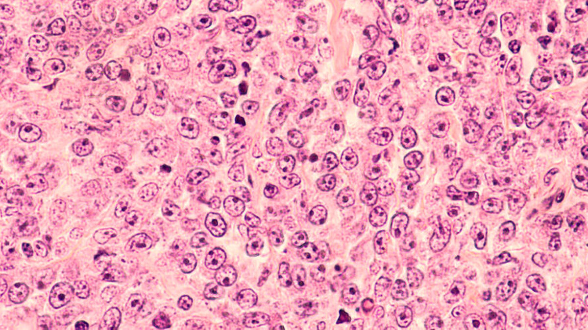 DLBCL: Besser Pola-R-CHP anstelle von R-CHOP in der Erstlinie?