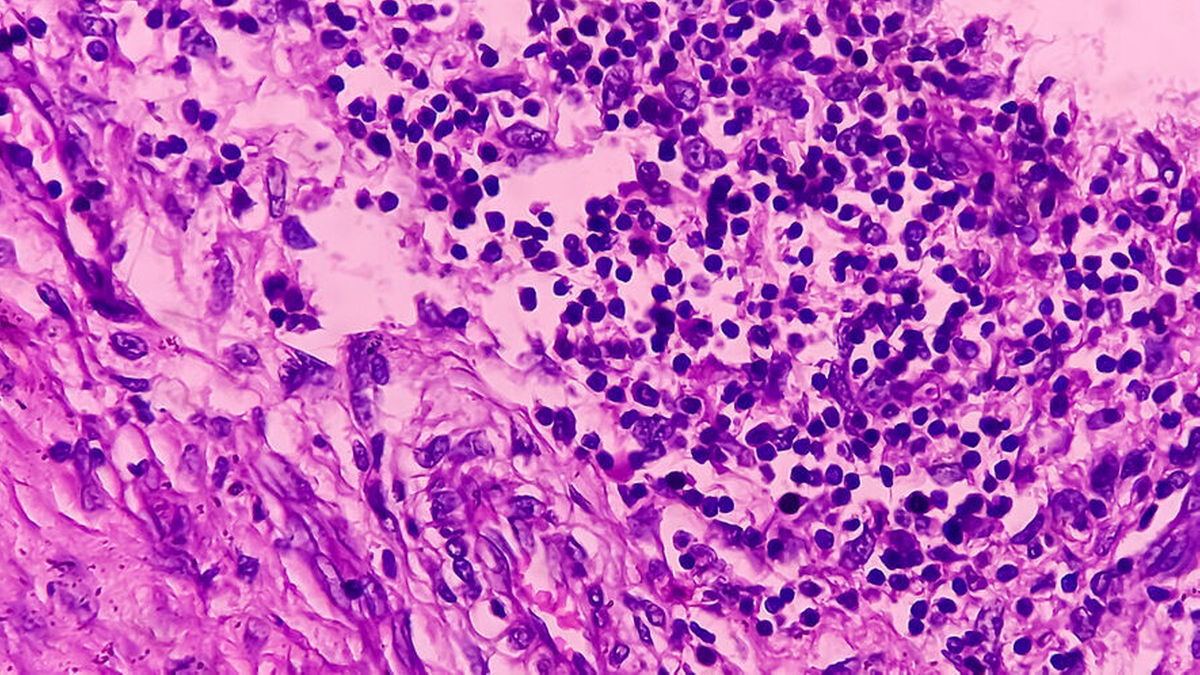 Kopf-Hals-Tumoren: Therapie mit Xevinapant vielversprechend