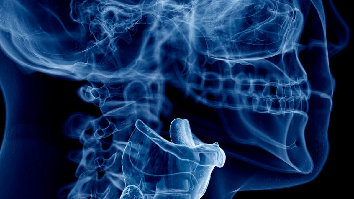 Xevinapant plus Radiochemotherapie: Vielversprechendes ...