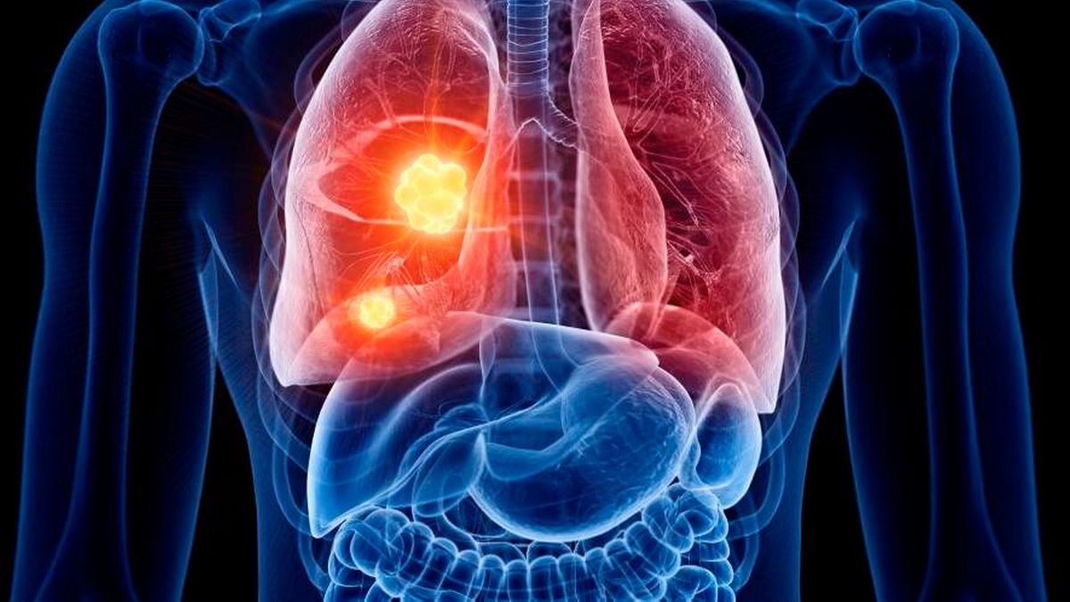 Neuer Checkpoint-Inhibitor: Vielversprechende erste Studiendaten für ...