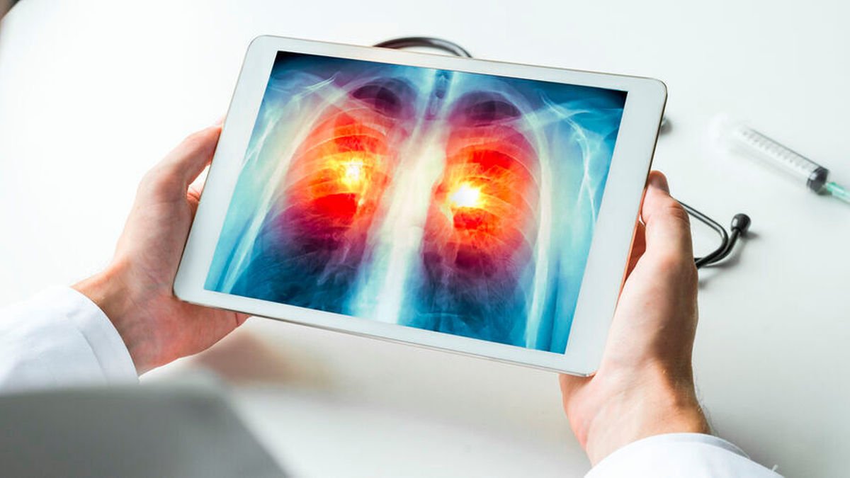 mNSCLC: Immunzellanalyse als Weichenstellung zur effektiven Therapie