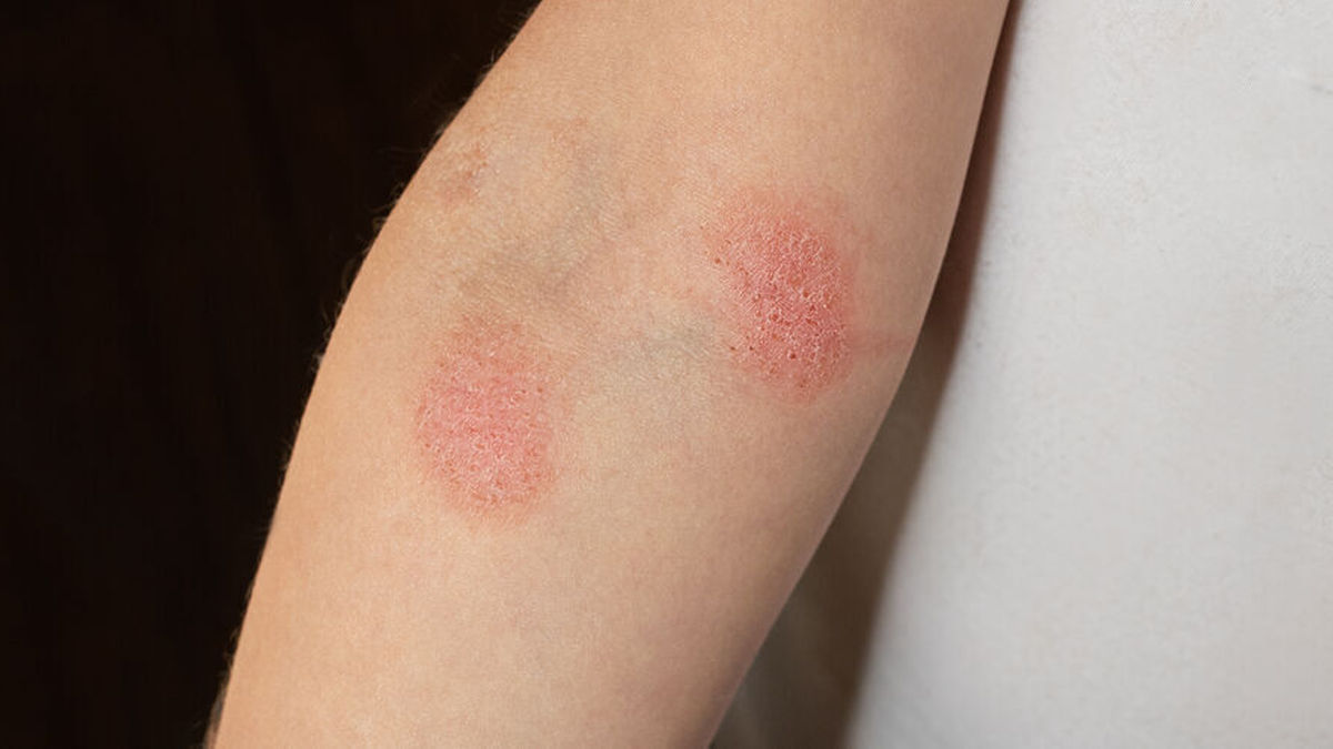 CCR4-gerichtete Therapie bei CTCL-Subtypen MF & SS