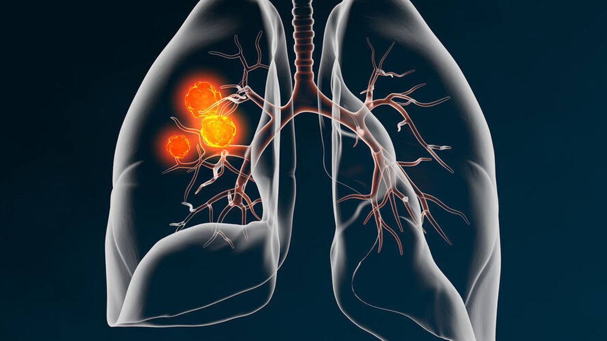 Lungenkrebs in Verbindung mit idiopathischer Lungenfibrose