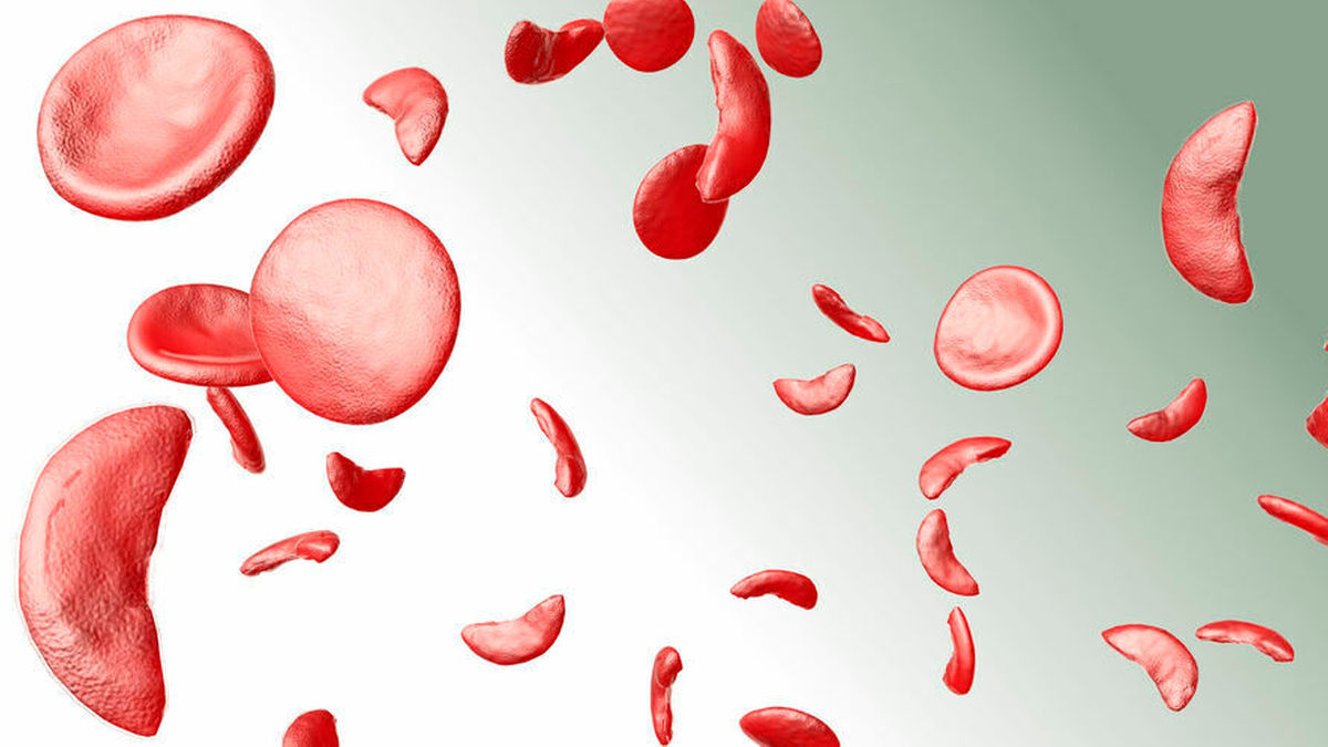 SCD: Hemmung der Sichelzellbildung vermindert die Hämolyse