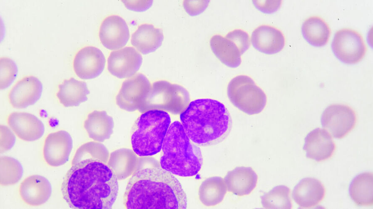 r/r LBCL: Dauerhafte Remissionen unter Liso-cel