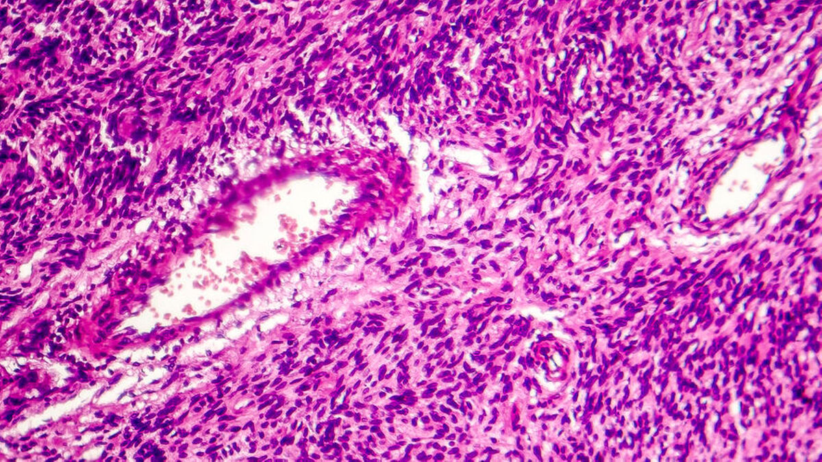 Diagnostik und Therapie von Weichteil- und Knochensarkomen