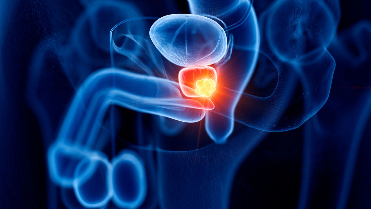 Die mpMRT der Prostata bei 550 Patienten mit Prostatakarzinom