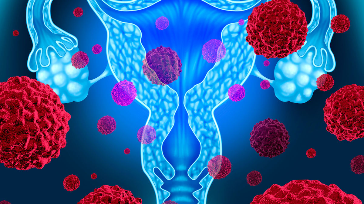 5-Jahres-Update von 309/KEYNOTE-775 beim fortgeschrittenem EC ...